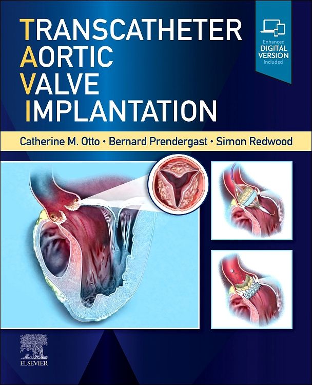 Transcatheter Aortic Valve Implantation: 1st edition | Edited by ...